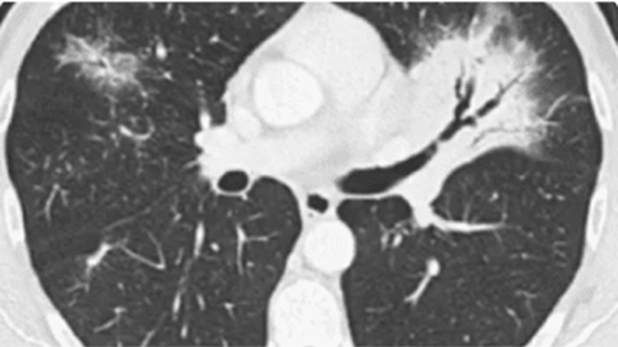 Diagnosing Interstitial Lung Disease | ILD Radiology Rounds