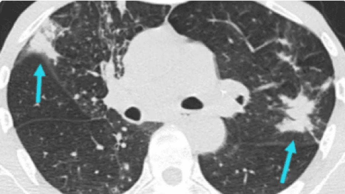 Different Features of ILD on HRCT | ILD Radiology Rounds
