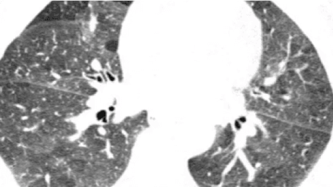 Different Features of ILD on HRCT | ILD Radiology Rounds