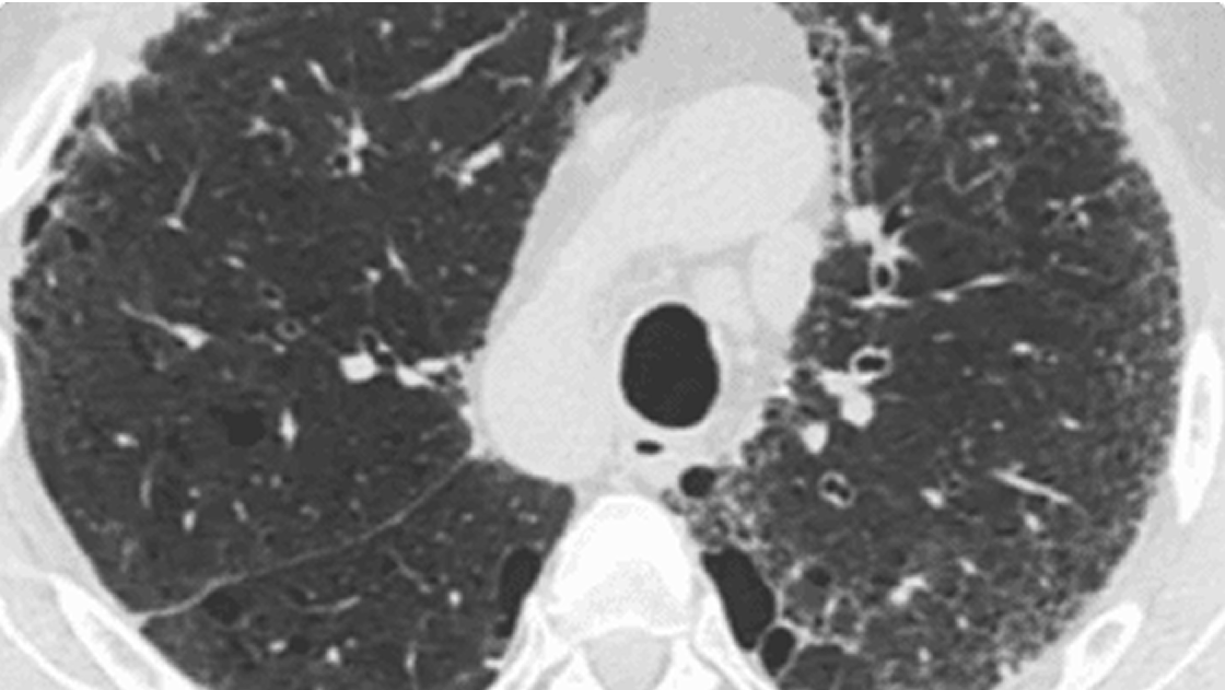 Different Features of ILD on HRCT | ILD Radiology Rounds