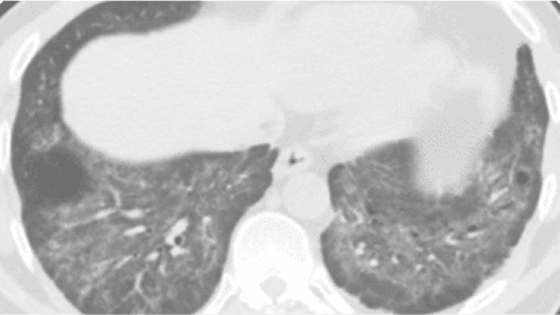 Diagnosing Interstitial Lung Disease | ILD Radiology Rounds