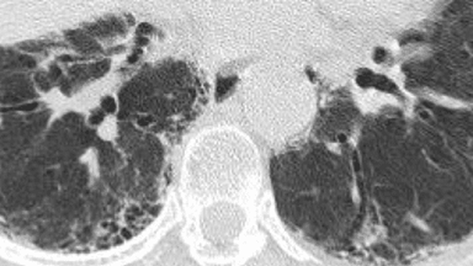 Recognizing Features of ILD on HRCT | ILD Radiology Rounds