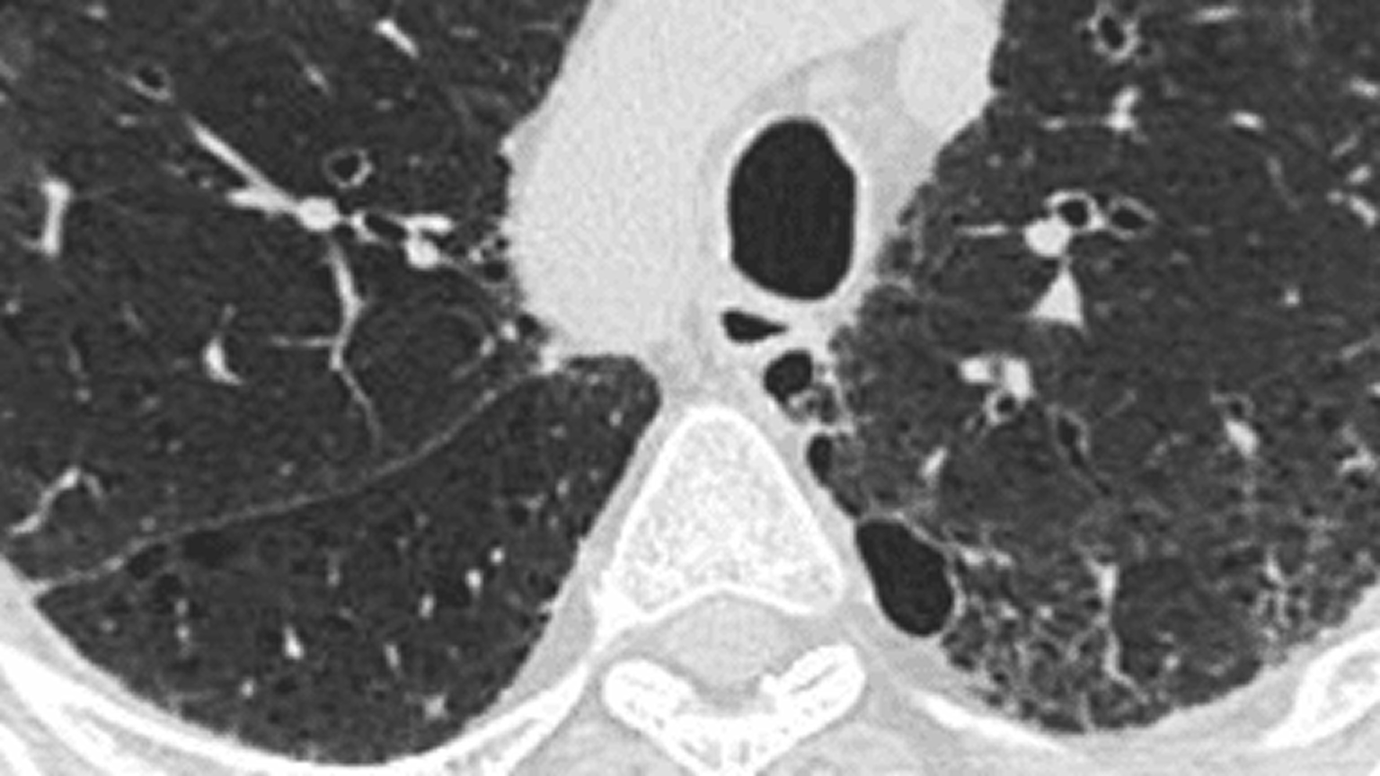 Recognizing Features of ILD on HRCT | ILD Radiology Rounds