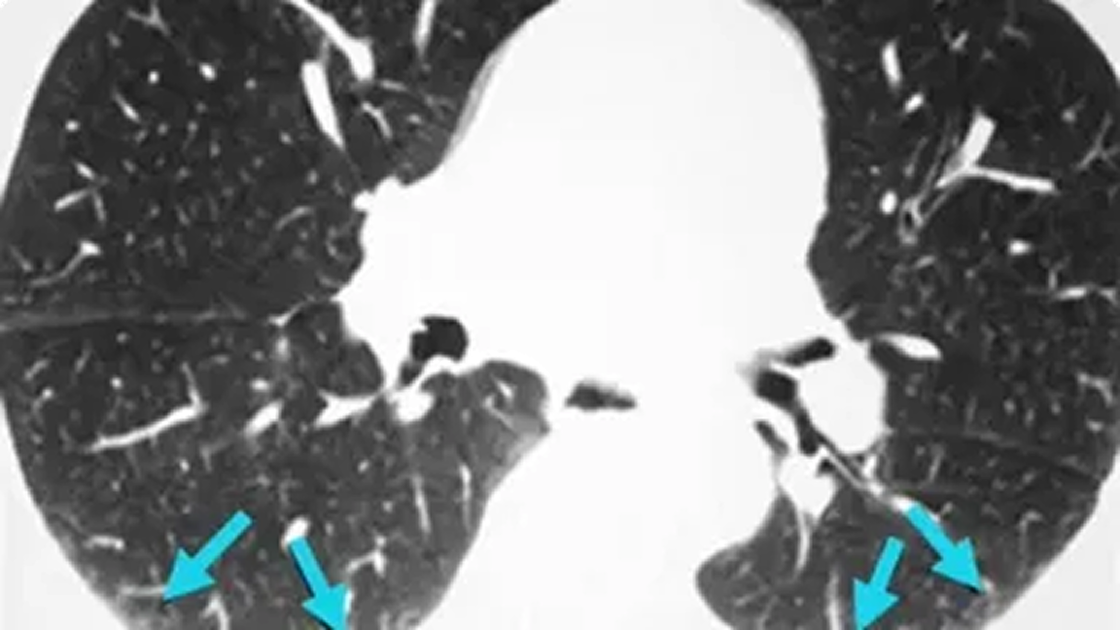 High Resolution CT Primer | ILD Radiology Rounds