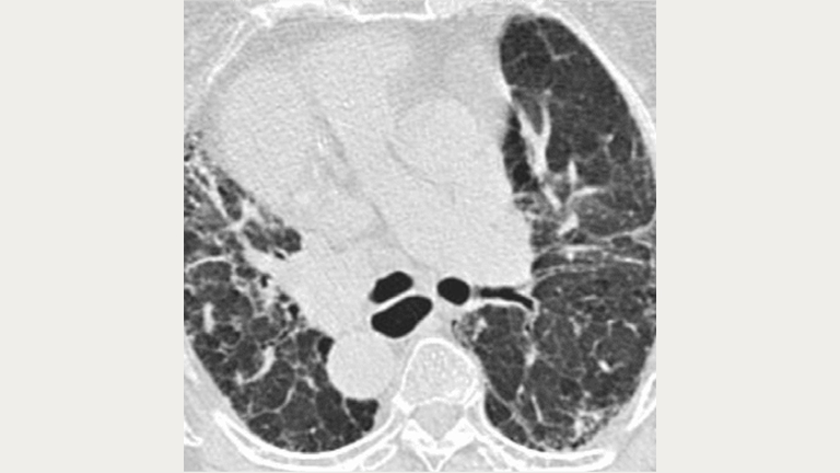 Differentiating Fibrotic HP, NSIP & UIP On HRCT | ILD Radiology Rounds