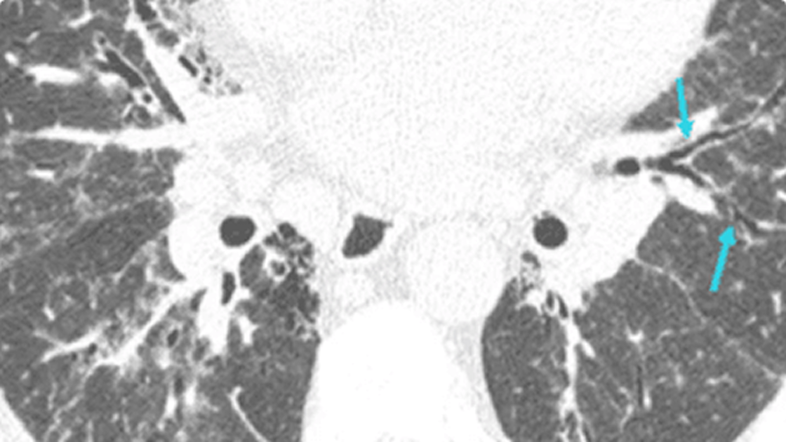 Different Features of ILD on HRCT | ILD Radiology Rounds