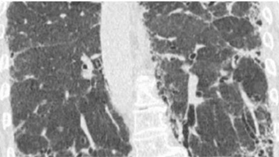 Diagnosing Interstitial Lung Disease | ILD Radiology Rounds