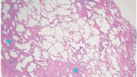 Fibrotic HP Case Study | ILD Radiology Rounds