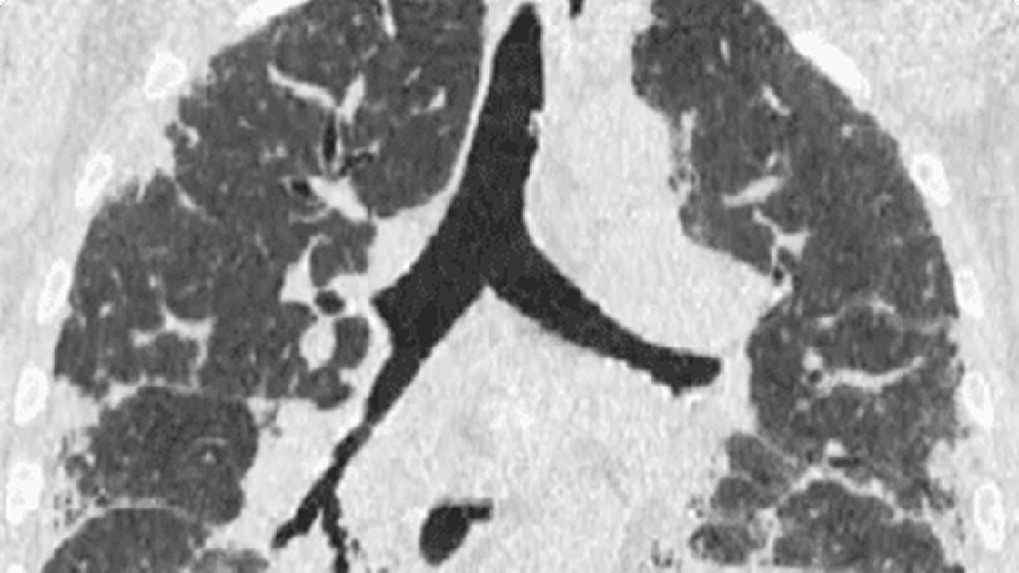 Different Features of ILD on HRCT | ILD Radiology Rounds