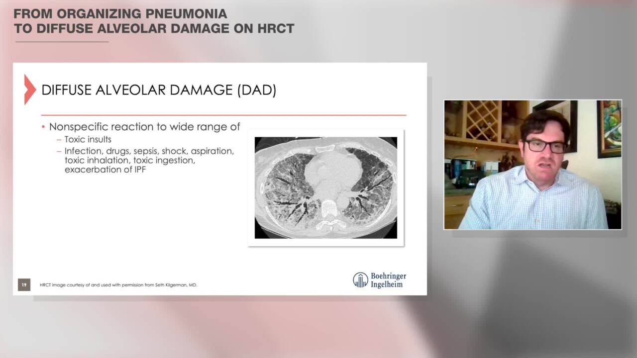 Interstitial Lung Disease Media Library | Insights in ILD