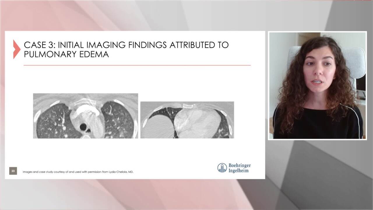 Interstitial Lung Disease Media Library | Insights in ILD