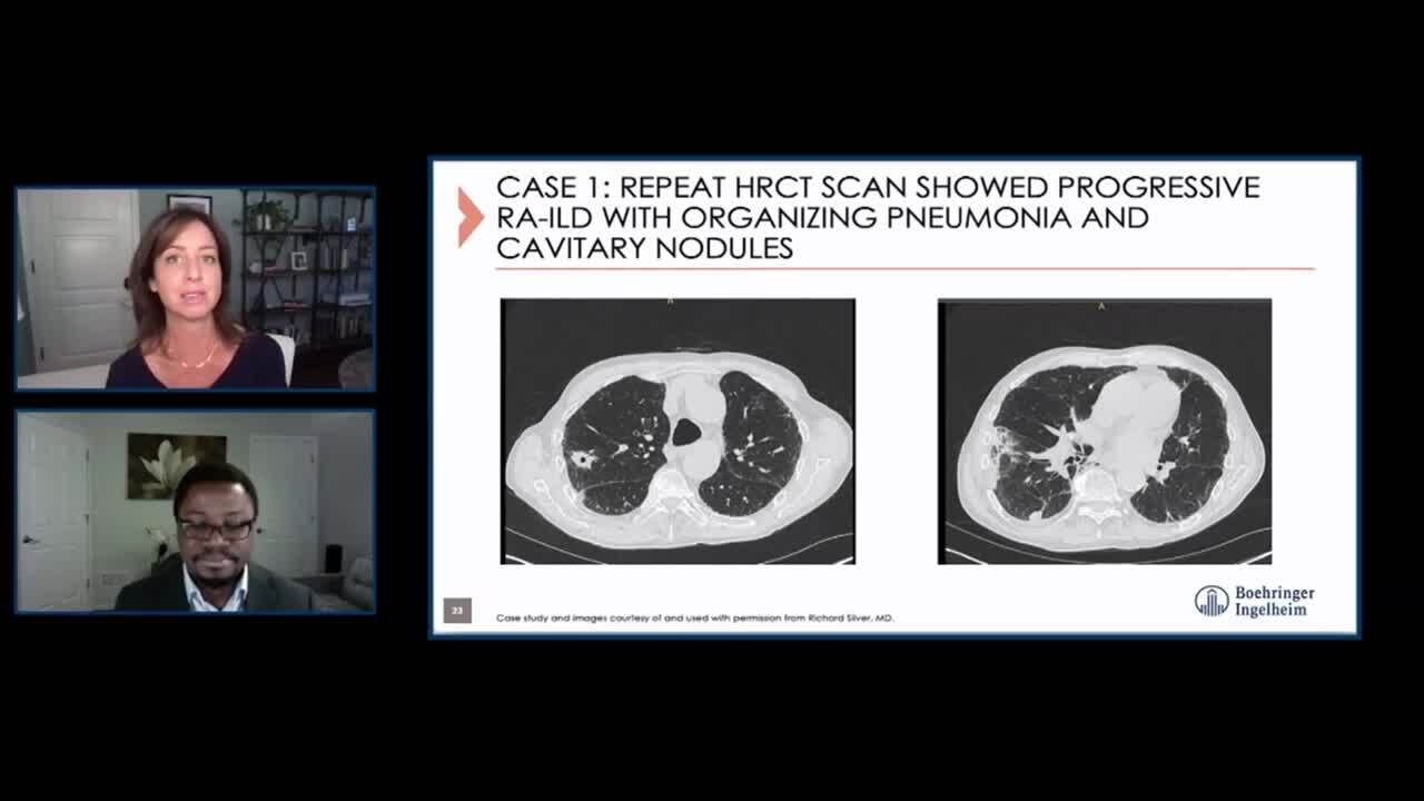 Interstitial Lung Disease Media Library | Insights in ILD