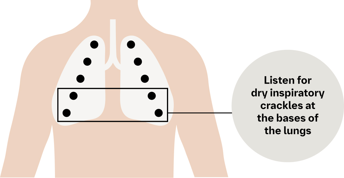 Recognizing Interstitial Lung Diseases (ILDs) | Sound The ILD Alarm
