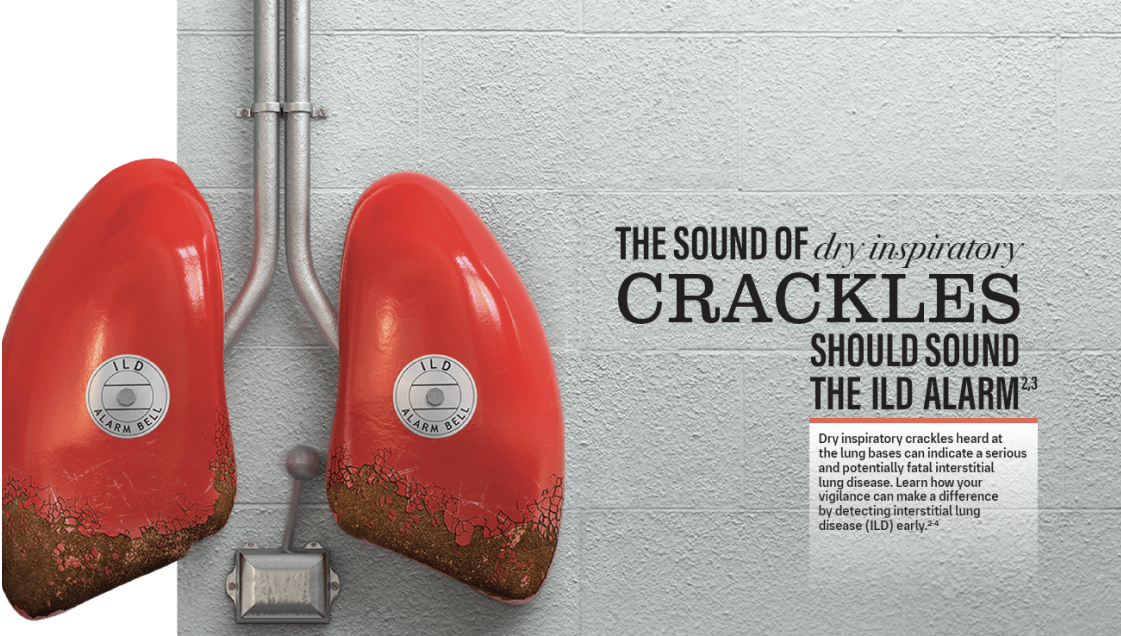 Interstitial Lung Disease (ILD) Resources | Sound The ILD Alarm