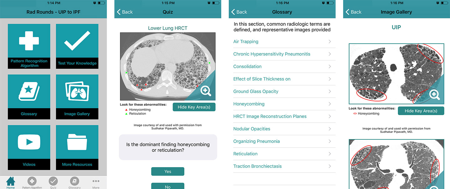 Rad Rounds - UIP to IPF | Insights in ILD