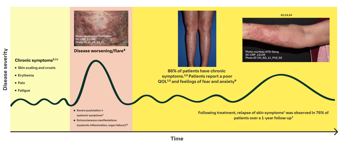 Generalized Pustular Psoriasis | BI Immunology Resources