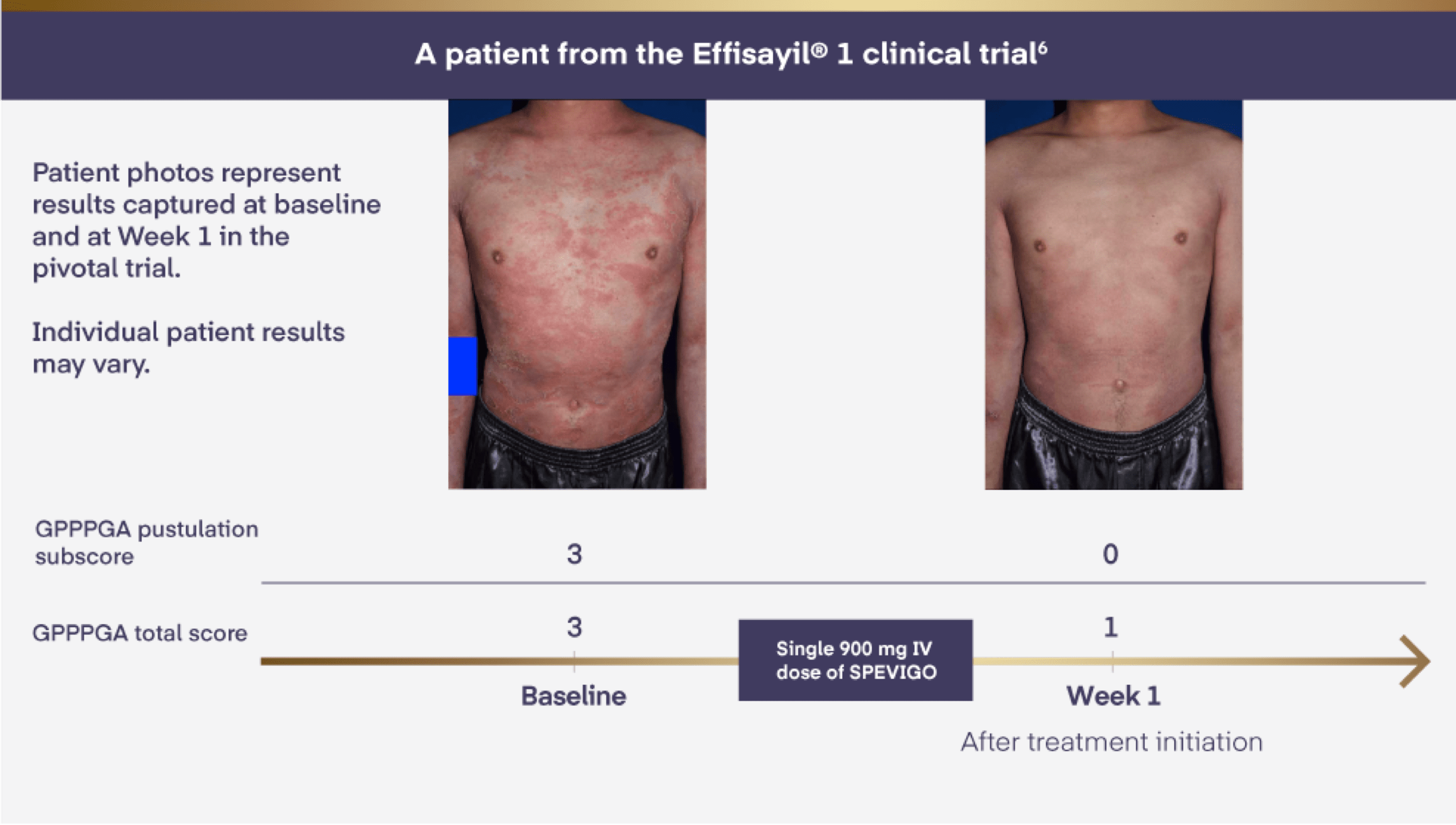GPP Flare Treatment Efficacy | Spevigo® (spesolimab-sbzo) Injection