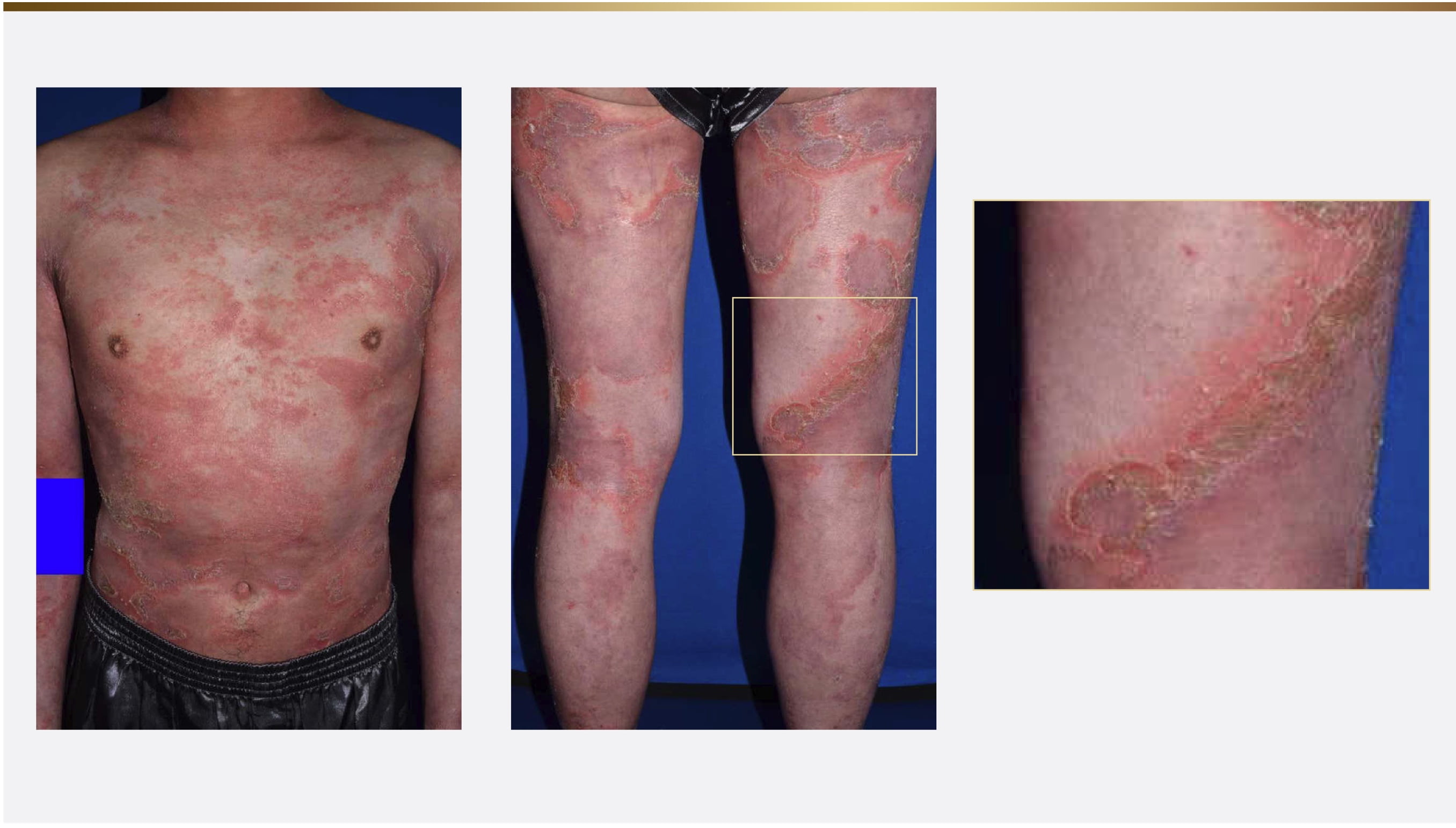 About GPP | Spevigo® (spesolimab-sbzo) Injection