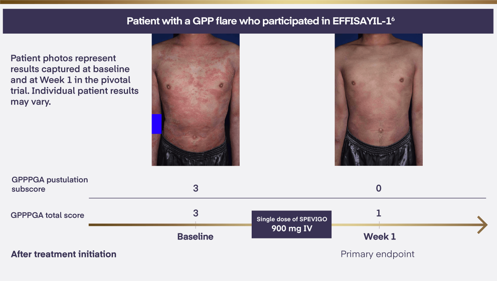 Spevigo® Efficacy Spesolimab Sbzo Injection For Intravenous Use