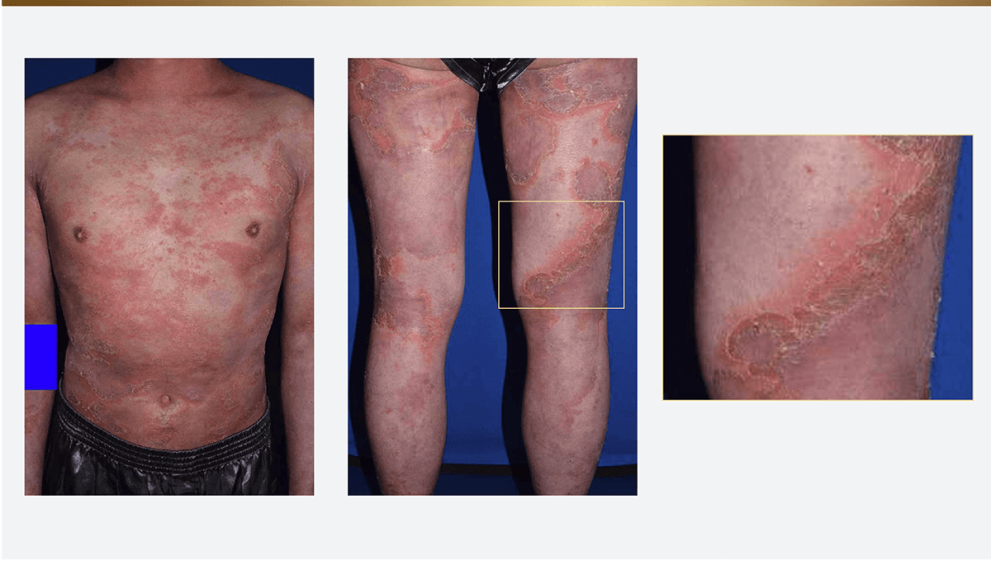 About GPP Flares | Spevigo® (spesolimab-sbzo) Injection for intravenous use