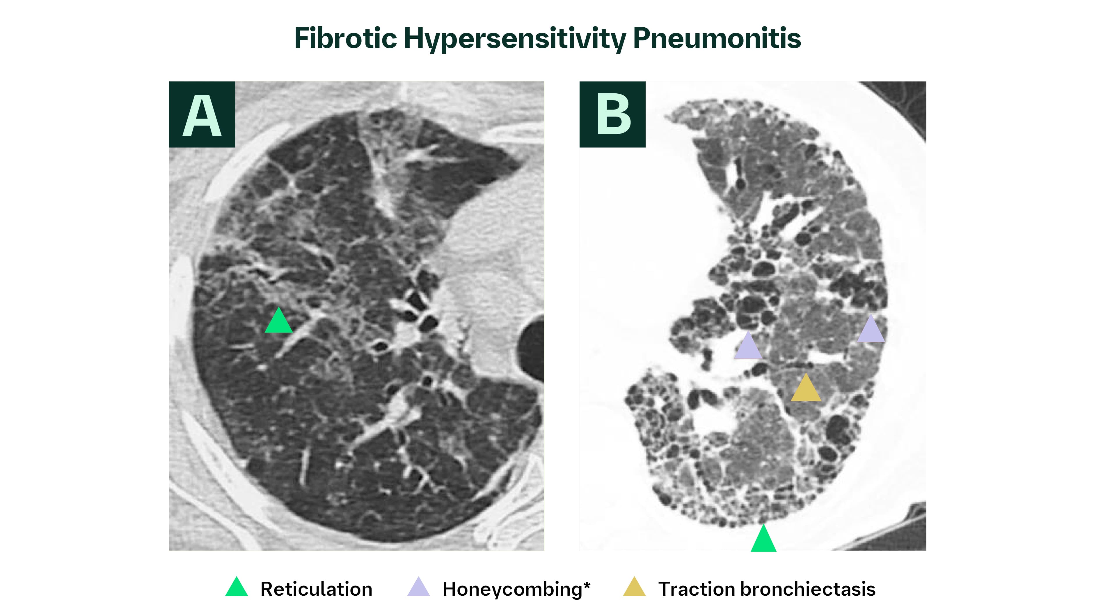 Hypersensitivity Pneumonitis (HP) | BI Respiratory Education