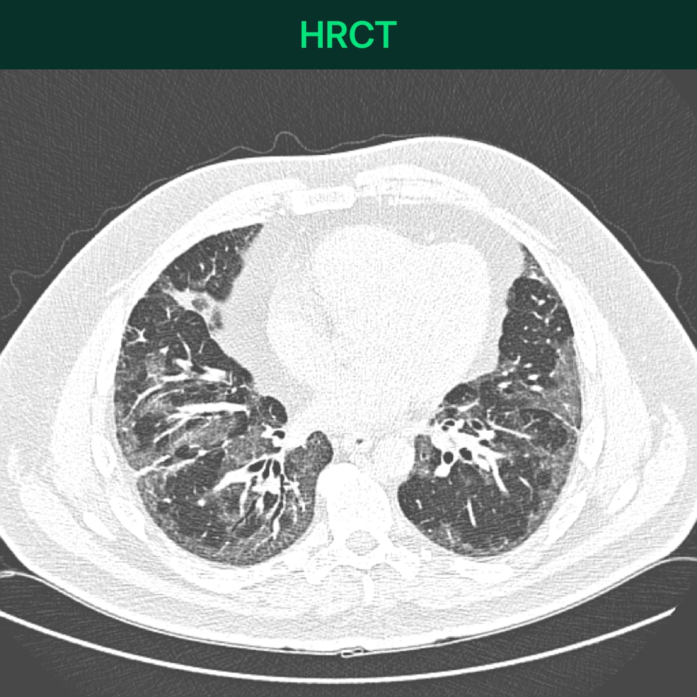 Mixed Connective Tissue Disease ILD (MCTD-ILD) | BI Respiratory Education